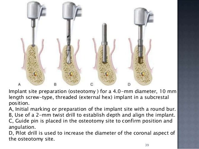 Basic implant surgery