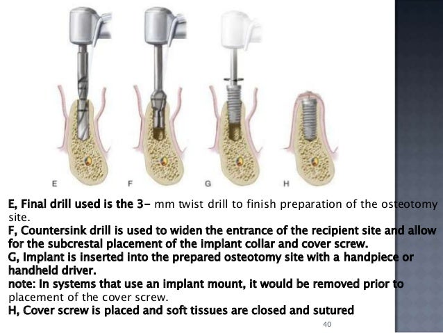 Basic implant surgery