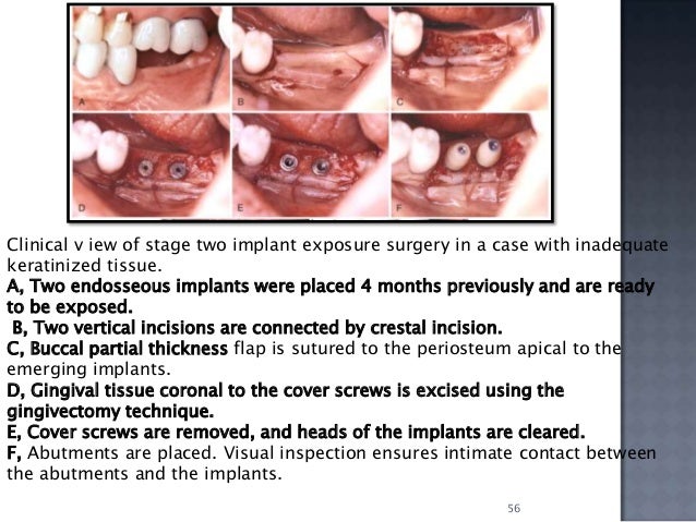 Basic implant surgery