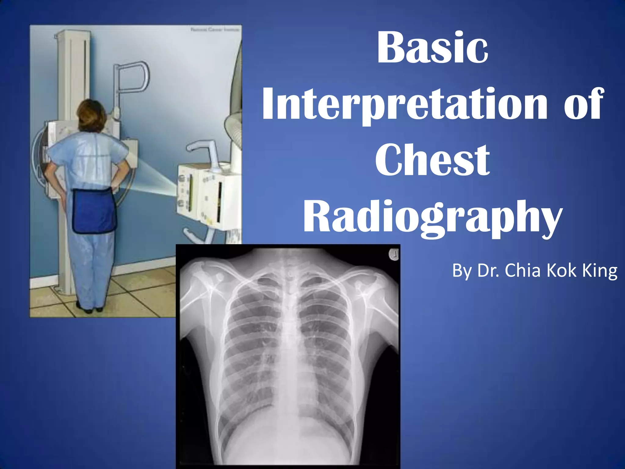 Basic interpretation of cxr | PPTX