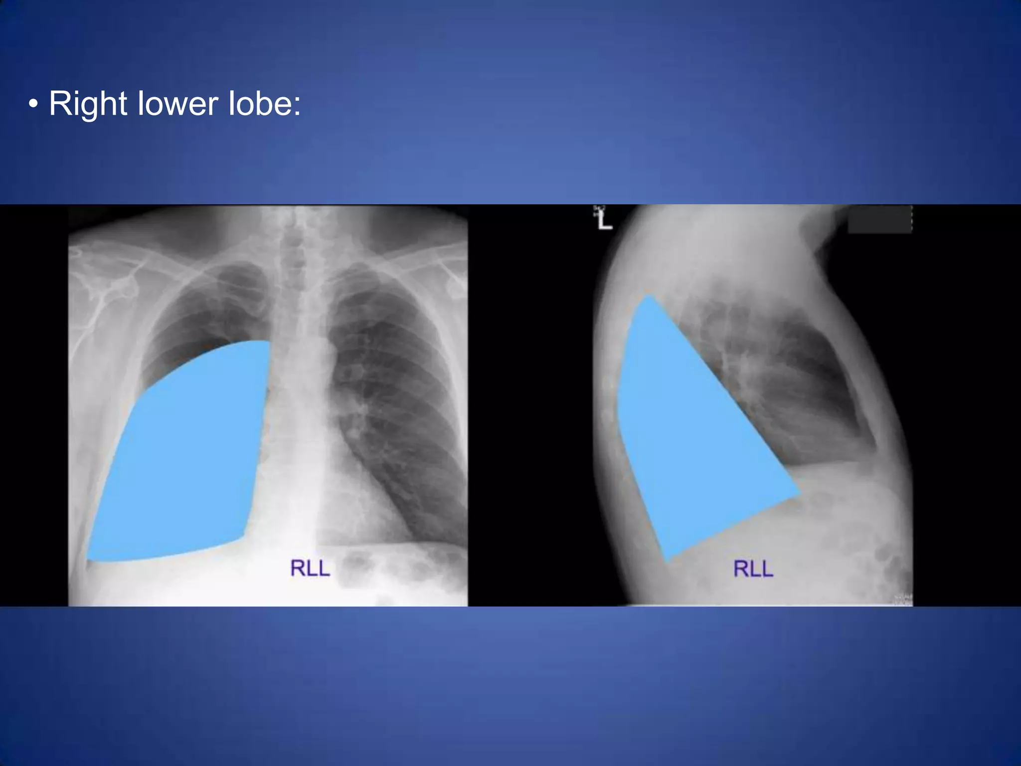 Basic interpretation of cxr | PPTX