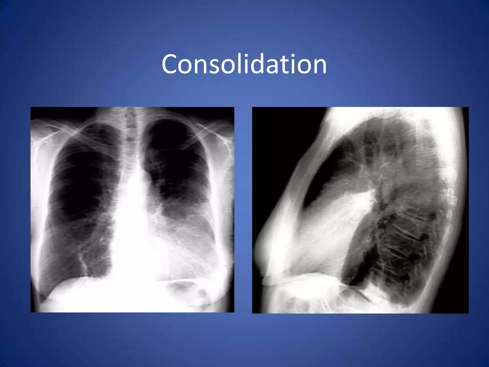 Basic interpretation of cxr | PPTX