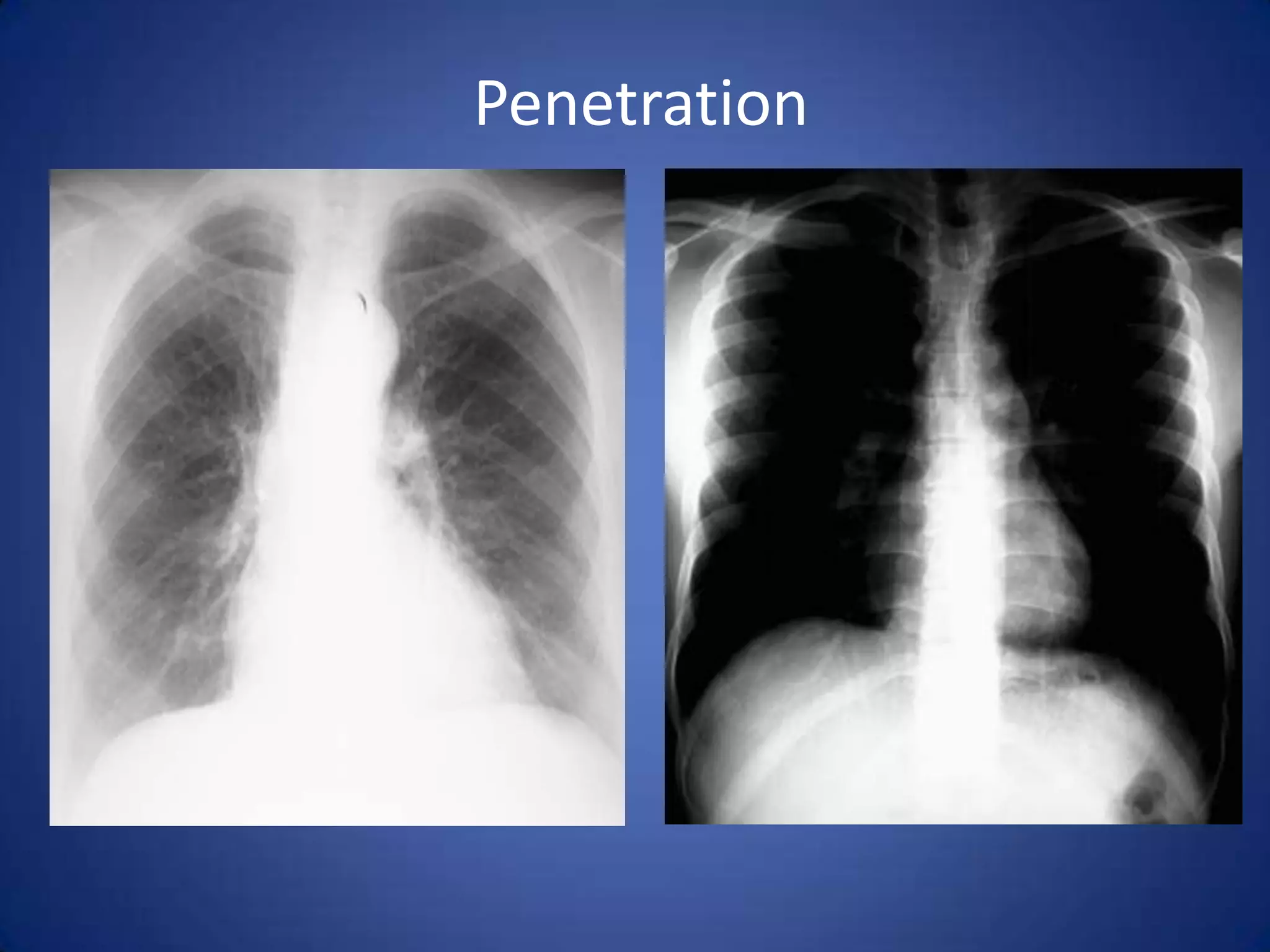 Basic interpretation of cxr | PPTX