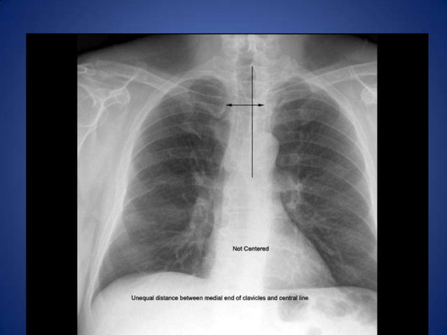 Basic interpretation of cxr | PPTX | Heart and Cardiovascular Diseases ...