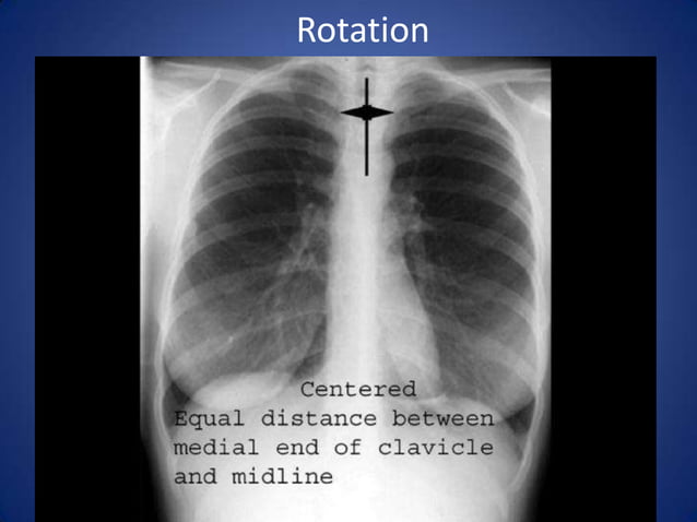 Basic interpretation of cxr | PPTX | Heart and Cardiovascular Diseases ...