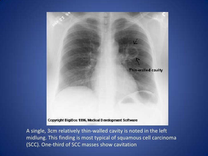 Basic interpretation of cxr