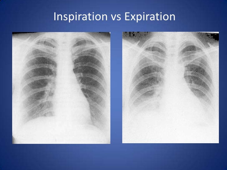 Basic interpretation of cxr