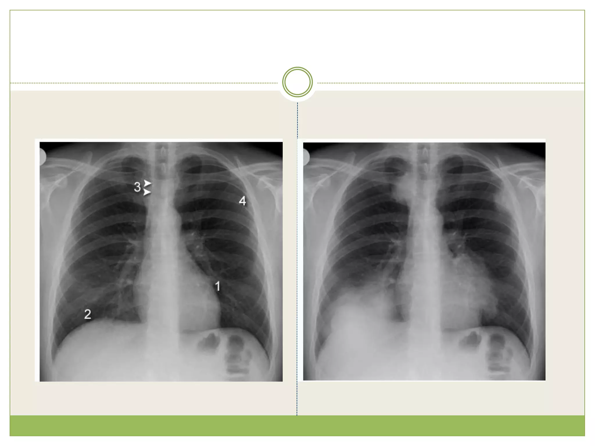 BASIC CHEST X-RAY INTERPRETATION | PPTX
