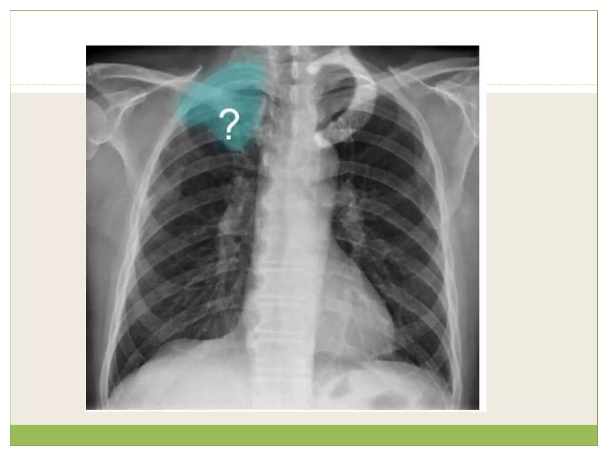 BASIC CHEST X-RAY INTERPRETATION | PPTX