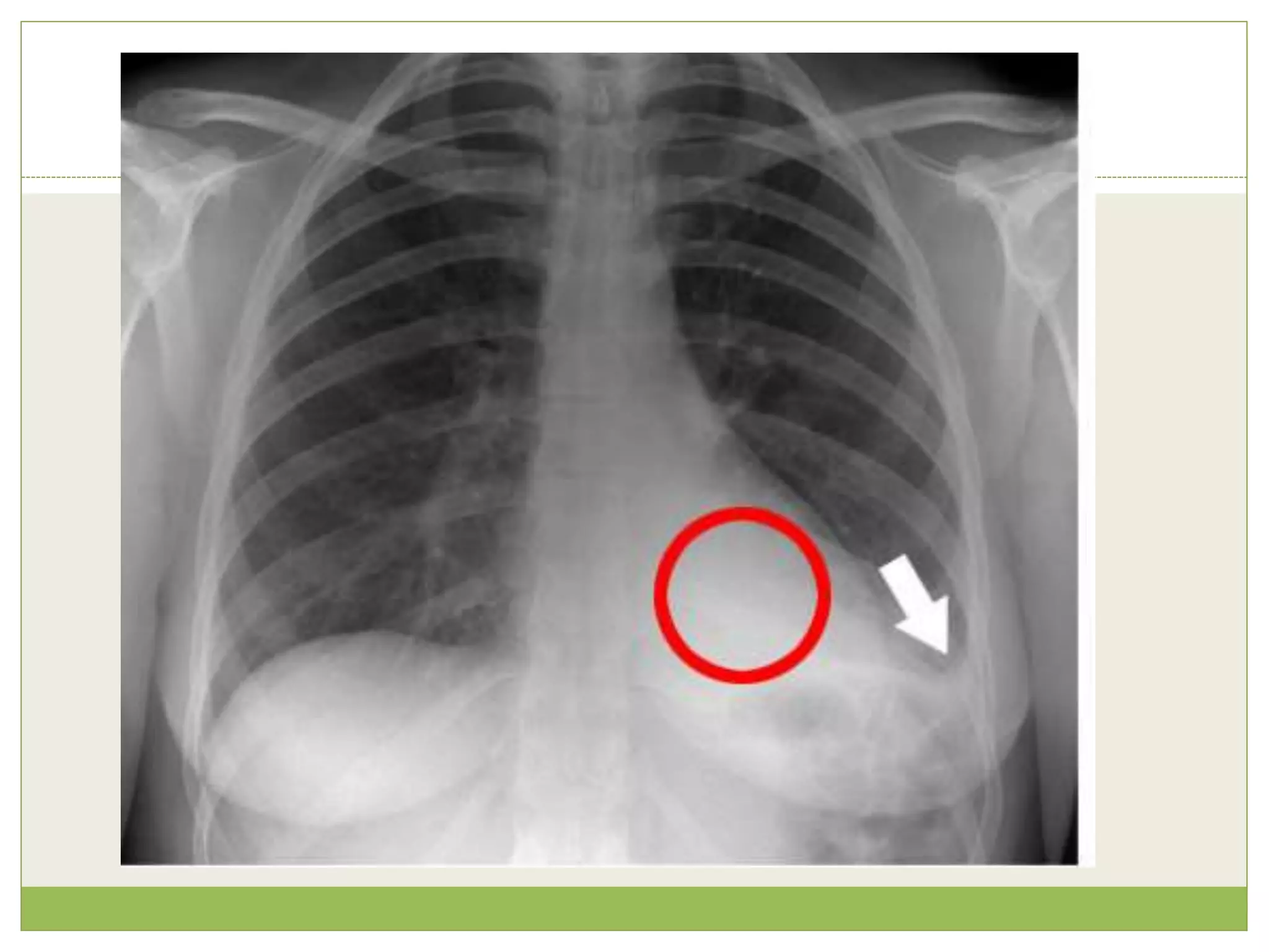 BASIC CHEST X-RAY INTERPRETATION | PPTX