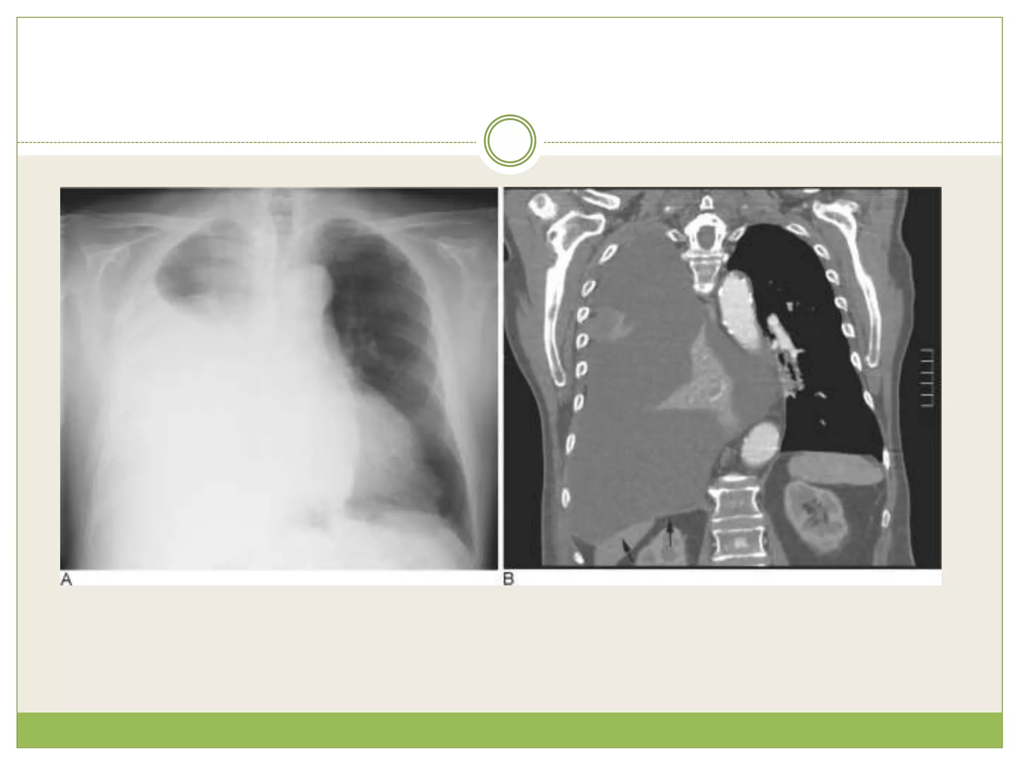 BASIC CHEST X-RAY INTERPRETATION | PPTX