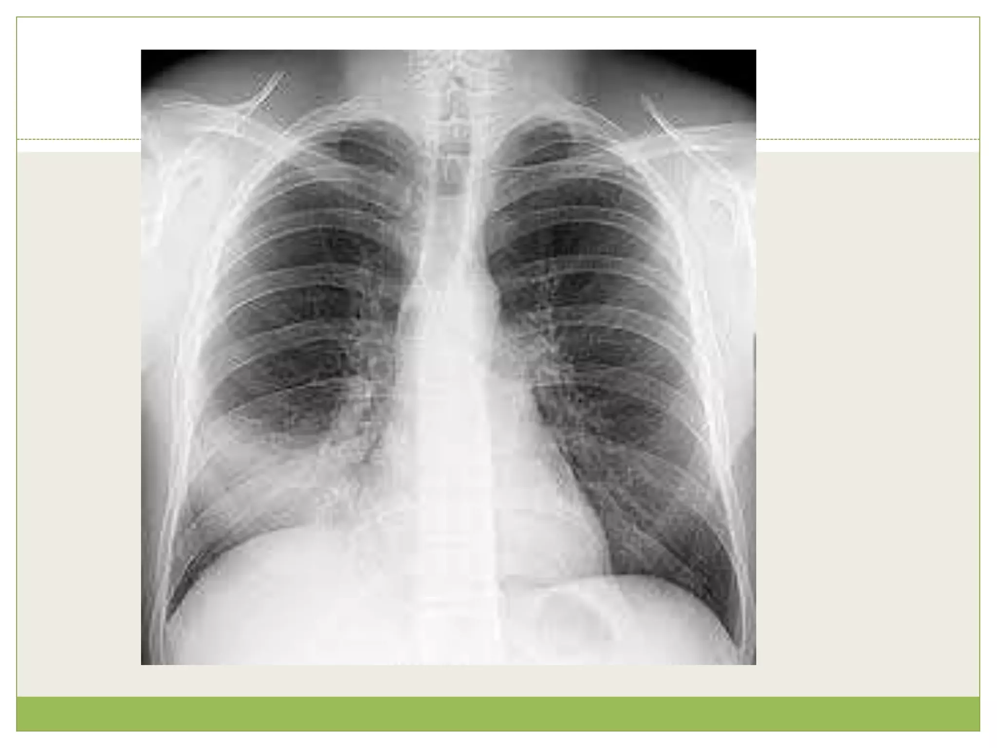 BASIC CHEST X-RAY INTERPRETATION | PPTX