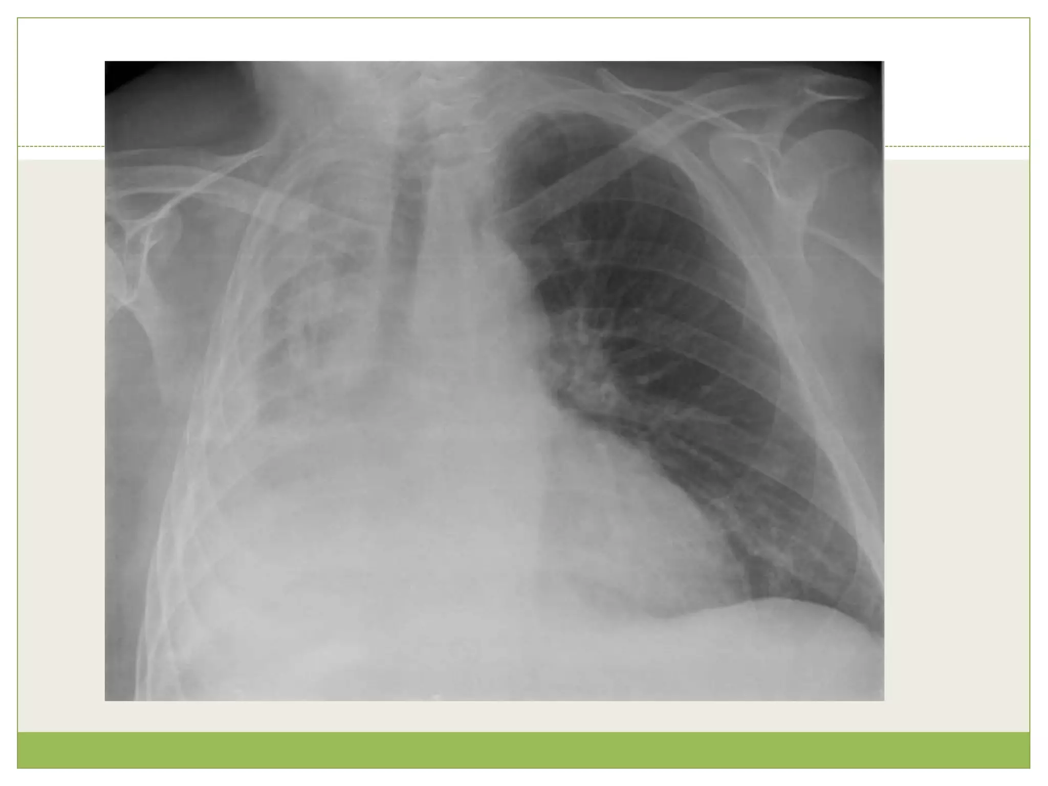 BASIC CHEST X-RAY INTERPRETATION | PPTX