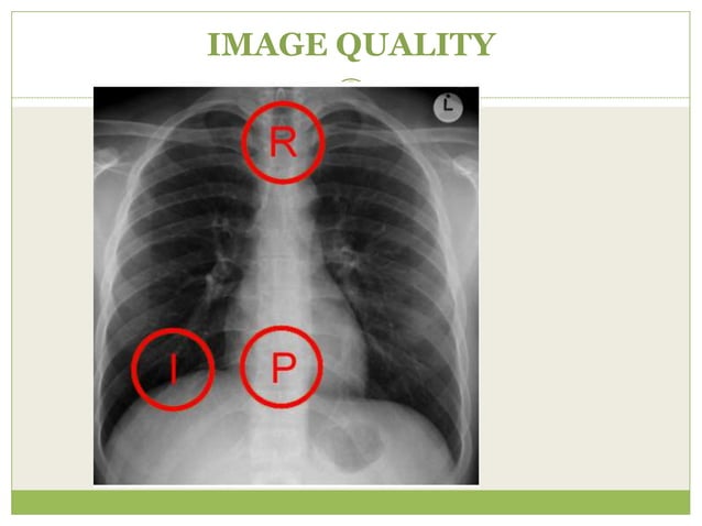 BASIC CHEST X-RAY INTERPRETATION | PPTX
