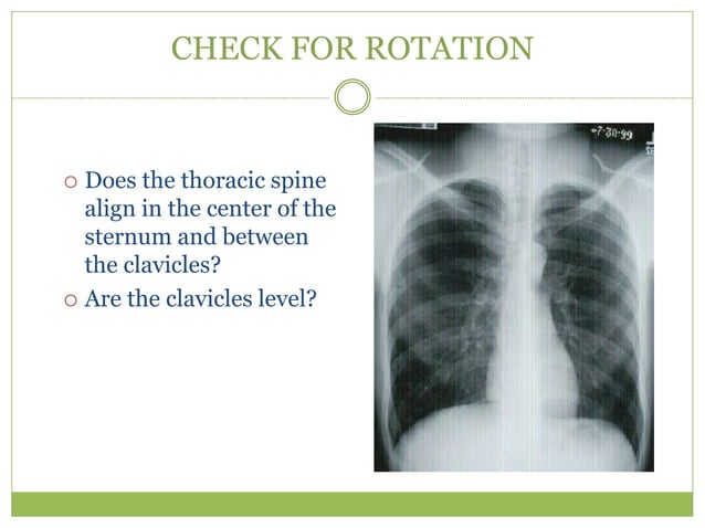 BASIC CHEST X-RAY INTERPRETATION | PPTX