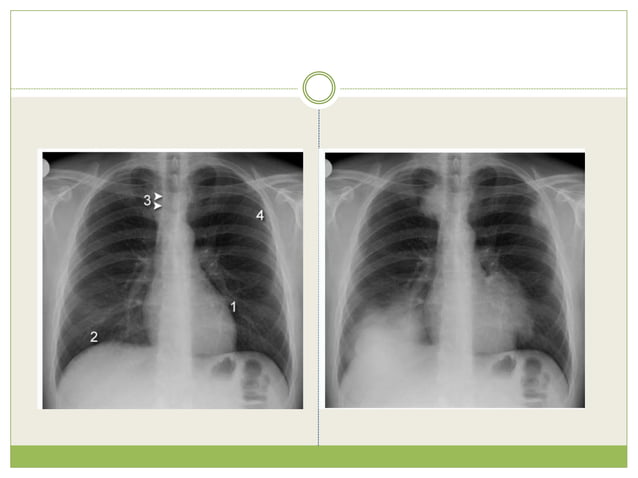 BASIC CHEST X-RAY INTERPRETATION | PPTX