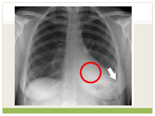 BASIC CHEST X-RAY INTERPRETATION | PPTX