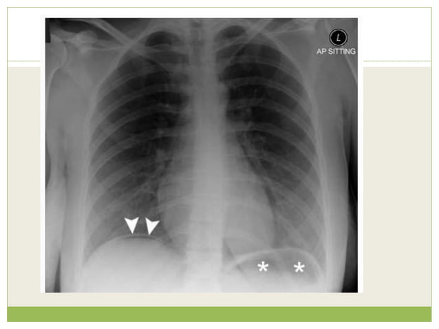 BASIC CHEST X-RAY INTERPRETATION | PPTX