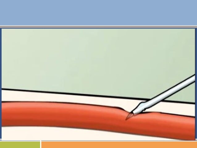 Basic IV Catheter Placement | PPT