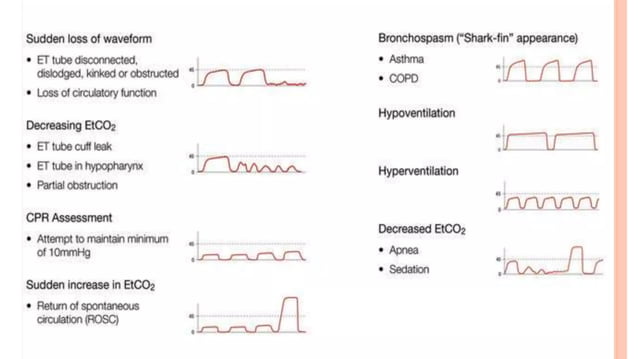 BASIC MONITORING IN ANAESTHESIA.....pptx