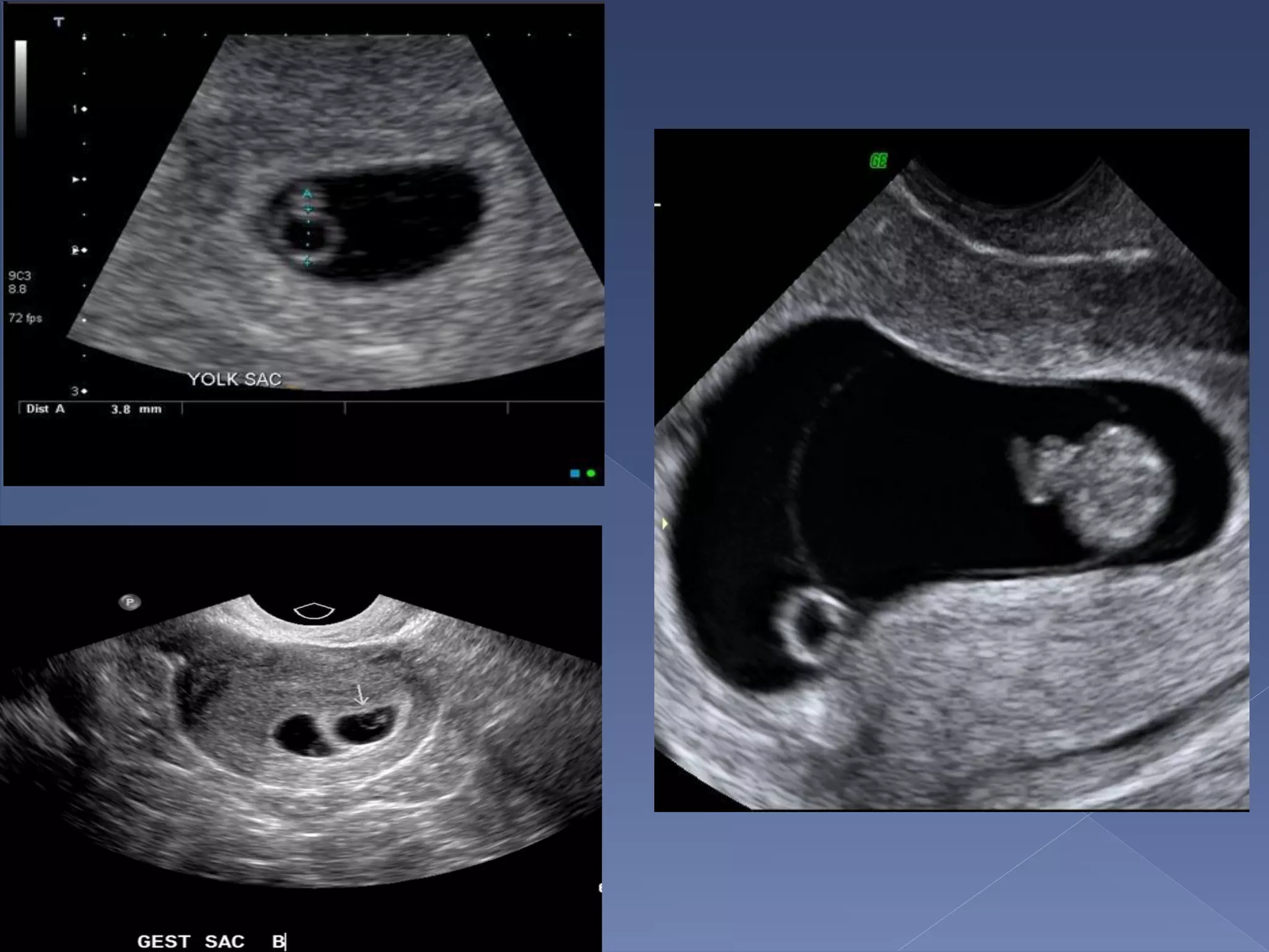 Basic Obstetric Ultrasound | PDF