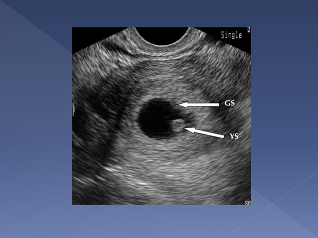 Basic Obstetric Ultrasound | PDF