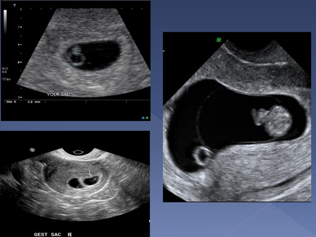 Basic Obstetric Ultrasound | PPT