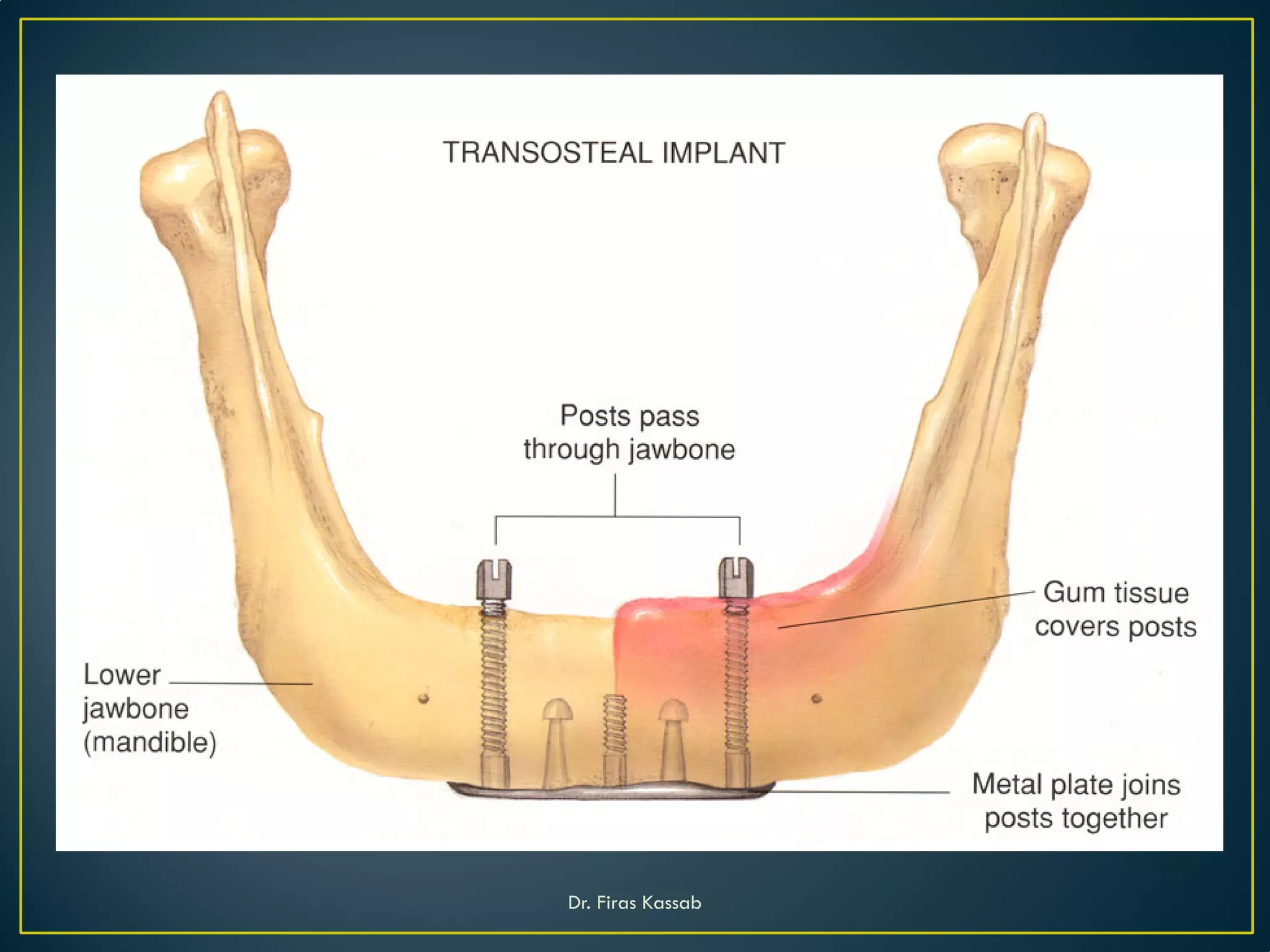 Basic of dental implant | PDF