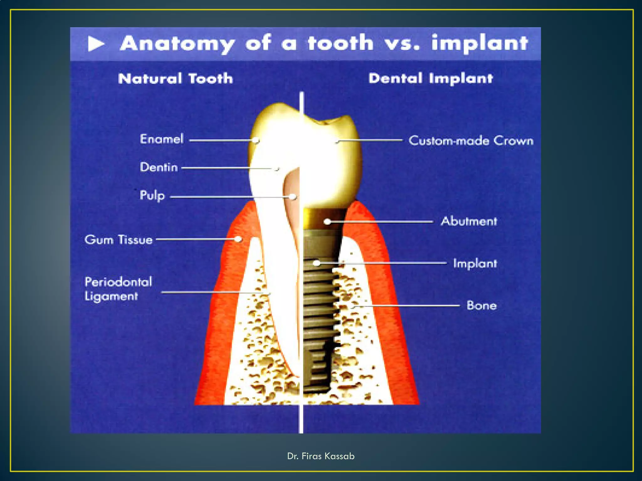Basic of dental implant | PDF