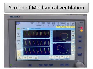 Basic of mechanical ventilation | PPTX