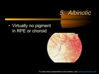 Basic opthalmoscopy findings - presentation at www.eyenirvaan.com