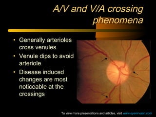 Basic opthalmoscopy findings - presentation at www.eyenirvaan.com