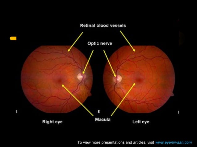 Basic opthalmoscopy findings - presentation at www.eyenirvaan.com | Eye ...