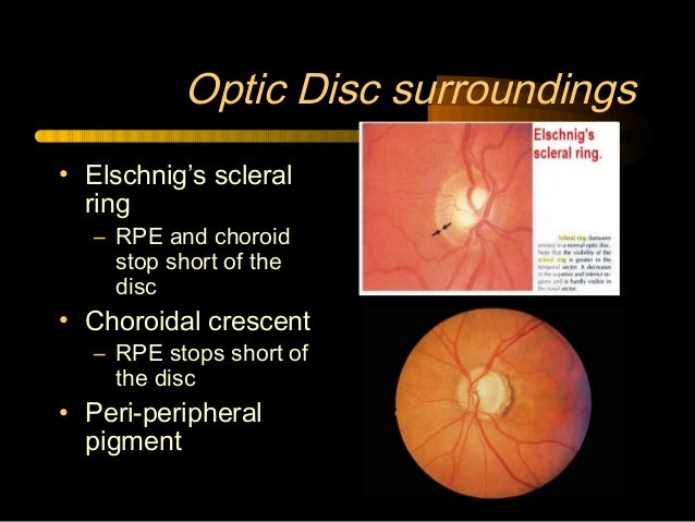 Basic opthalmoscopy findings - presentation at www.eyenirvaan.com