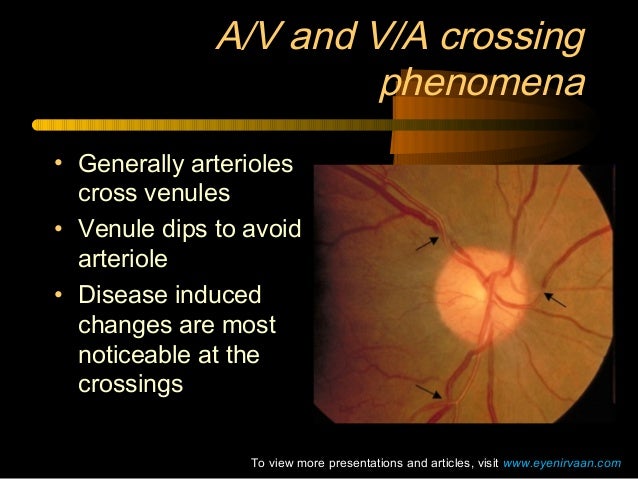 Basic opthalmoscopy findings - presentation at www.eyenirvaan.com