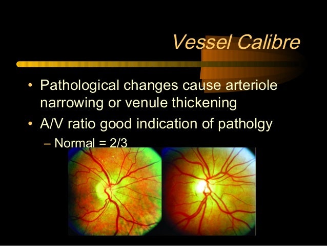 Basic opthalmoscopy findings - presentation at www.eyenirvaan.com