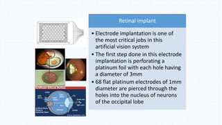 Basic overview of an artificial eye | PPT