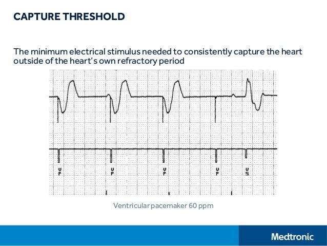 Basic pacing concepts