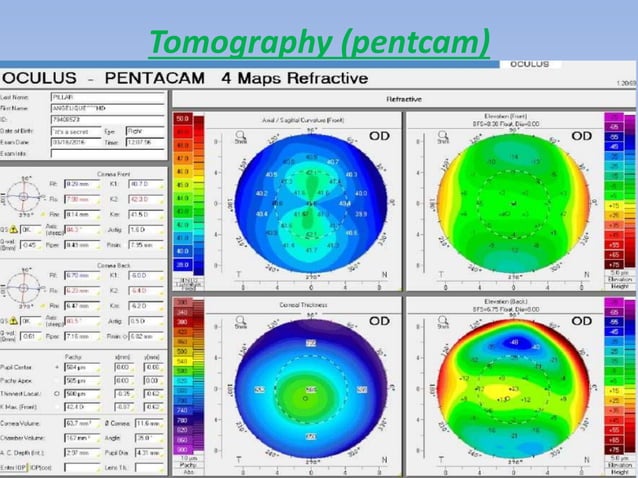 Basic pentcam for refractive surgery decision | PPTX | Eye and Vision ...