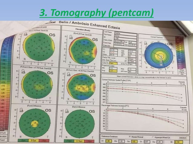 Basic pentcam for refractive surgery decision | PPTX | Eye and Vision ...