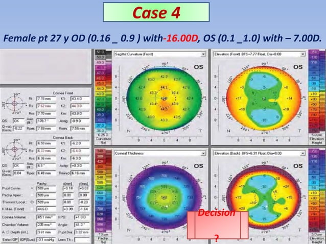 Basic pentcam for refractive surgery decision | PPTX | Eye and Vision ...