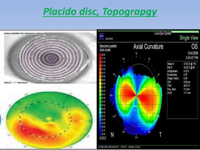 Basic pentcam for refractive surgery decision | PPTX | Eye and Vision ...