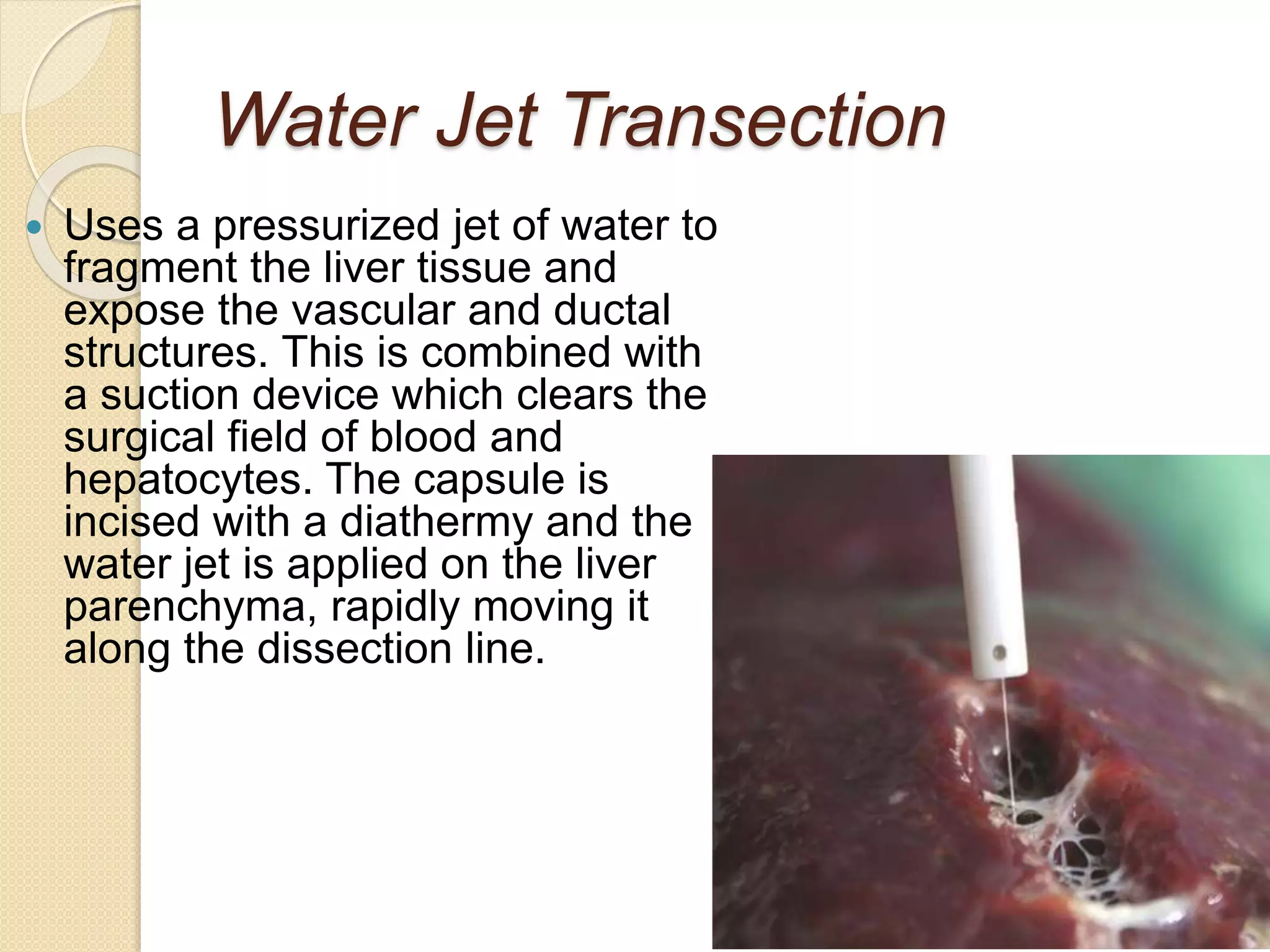 Basic principle of liver resection | PPTX