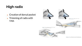 Basic principle of rhinoplasty. by venukumar.t | PPTX