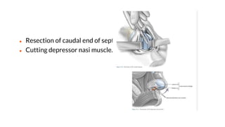 Basic principle of rhinoplasty. by venukumar.t | PPTX
