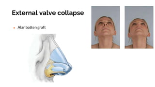 Basic principle of rhinoplasty. by venukumar.t | PPTX