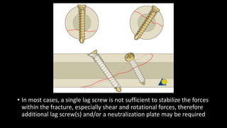 Basic principles internal fixation | PDF