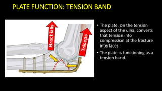 Basic principles internal fixation | PDF