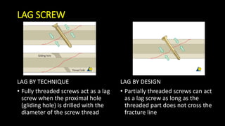 Basic principles internal fixation | PDF