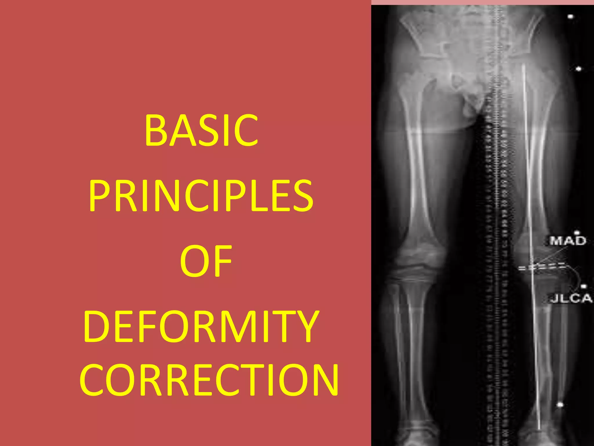 Basic principles of deformity correction | PPTX